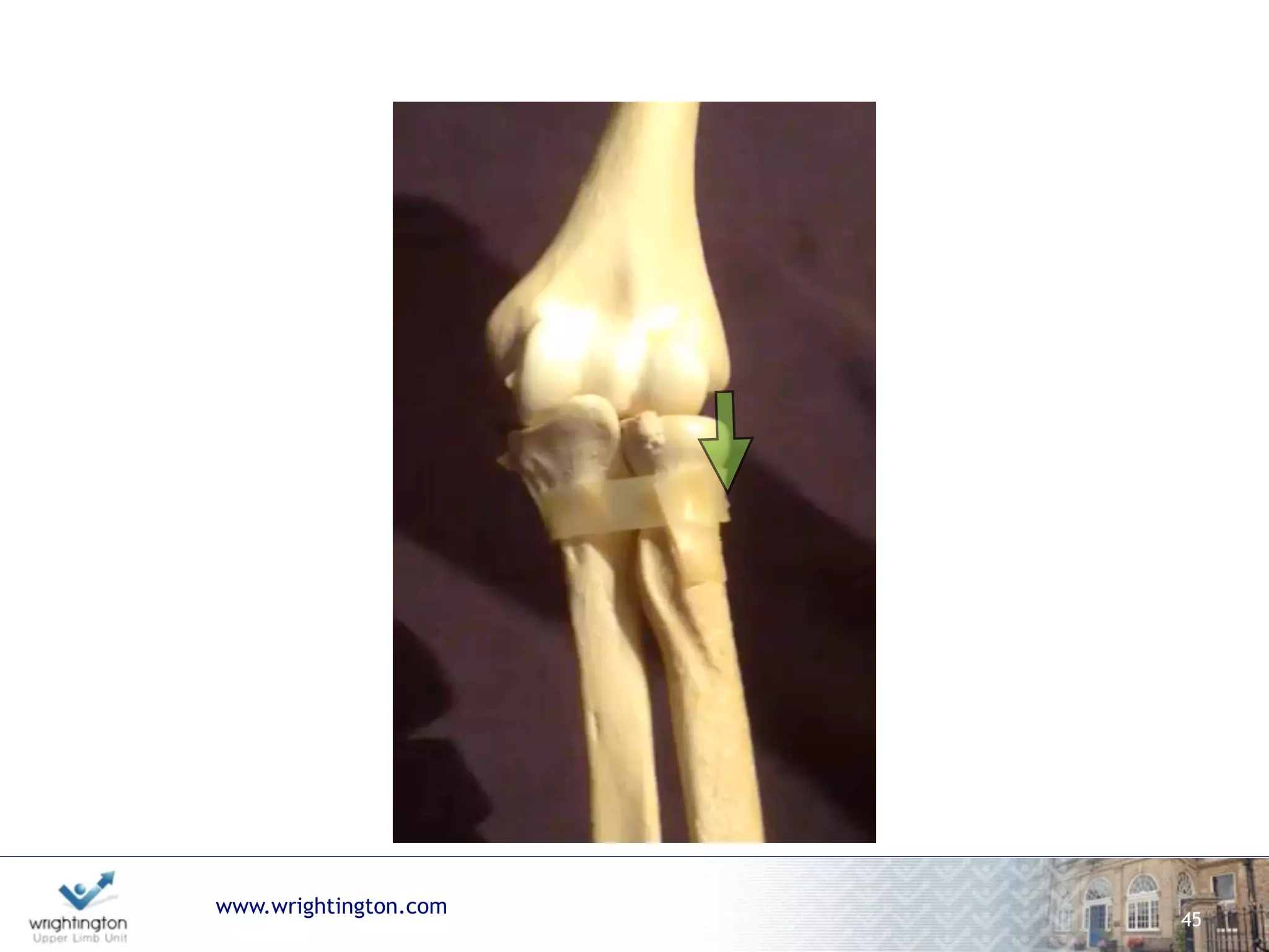 Elbow fracture dislocations adam watts | PDF