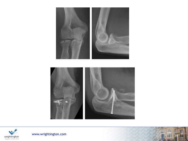 Elbow fracture dislocations adam watts | PDF