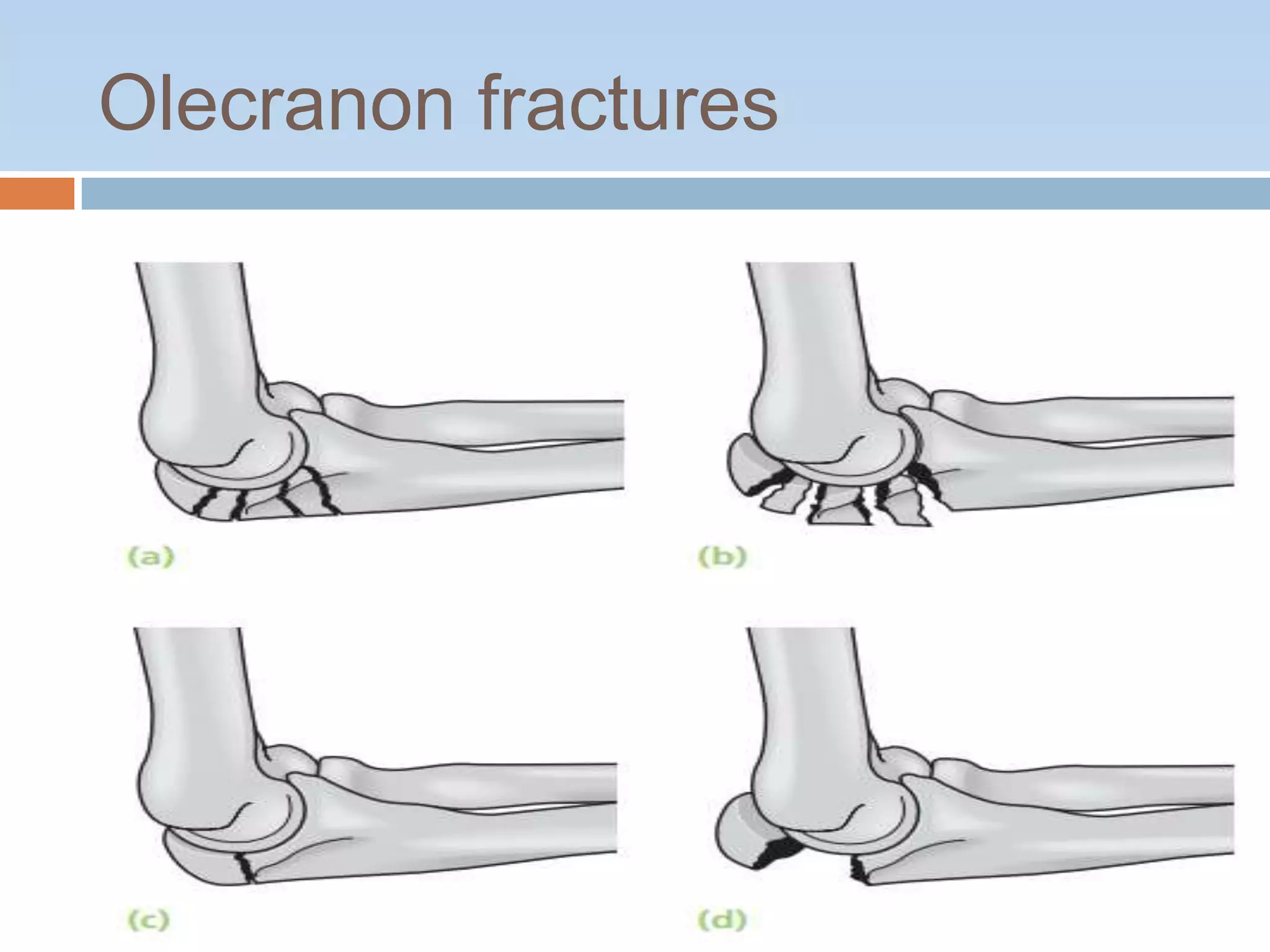 Elbow fractures and dislocations | PPTX