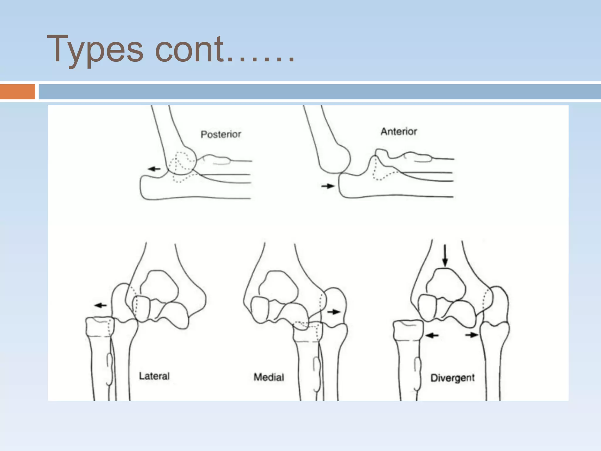 Elbow fractures and dislocations | PPTX