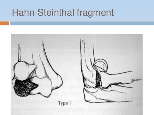Elbow fractures and dislocations