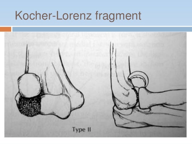 Elbow fractures and dislocations