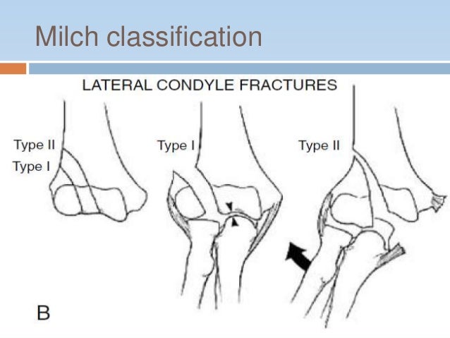 Elbow fractures and dislocations