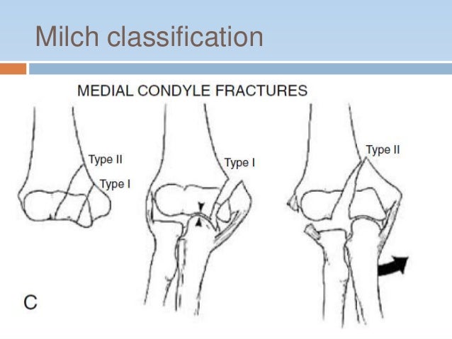 Elbow fractures and dislocations