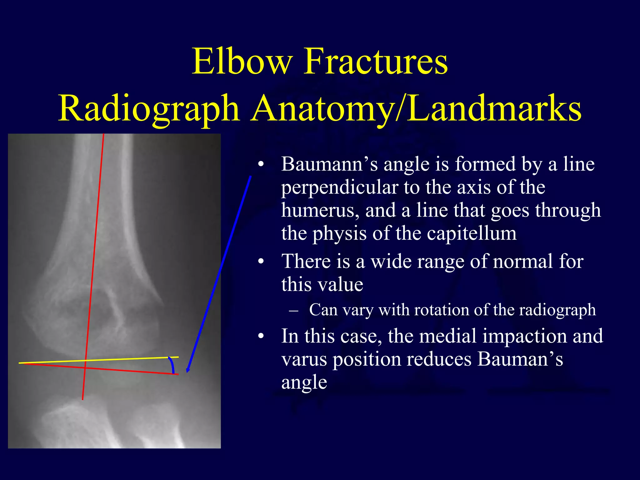 ELBOW_FRACTURE& Supracondylar fracture .ppt