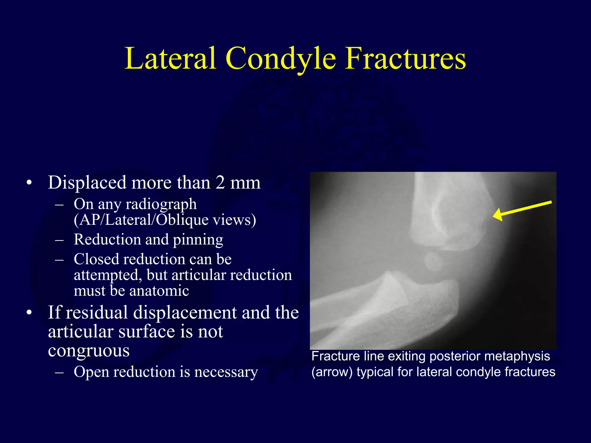 ELBOW_FRACTURE& Supracondylar fracture .ppt