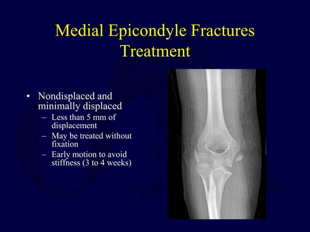 ELBOW_FRACTURE& Supracondylar fracture .ppt | First Aid | Injuries