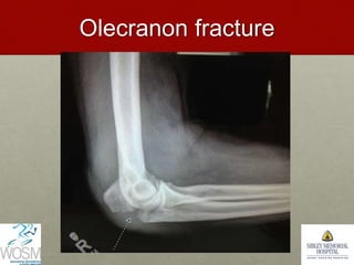 Elbow Injuries | PPTX