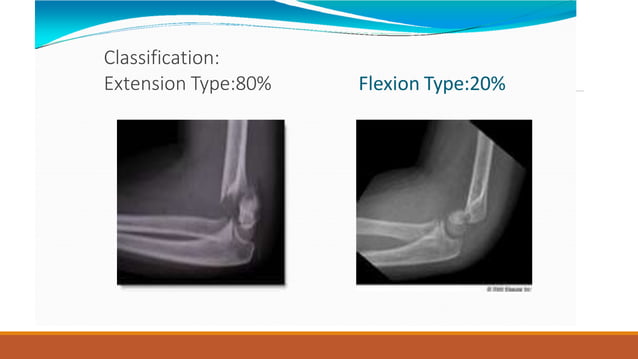 elbow injury.pdf | Death, Injury, or Military Conflict | Sensitive Topics