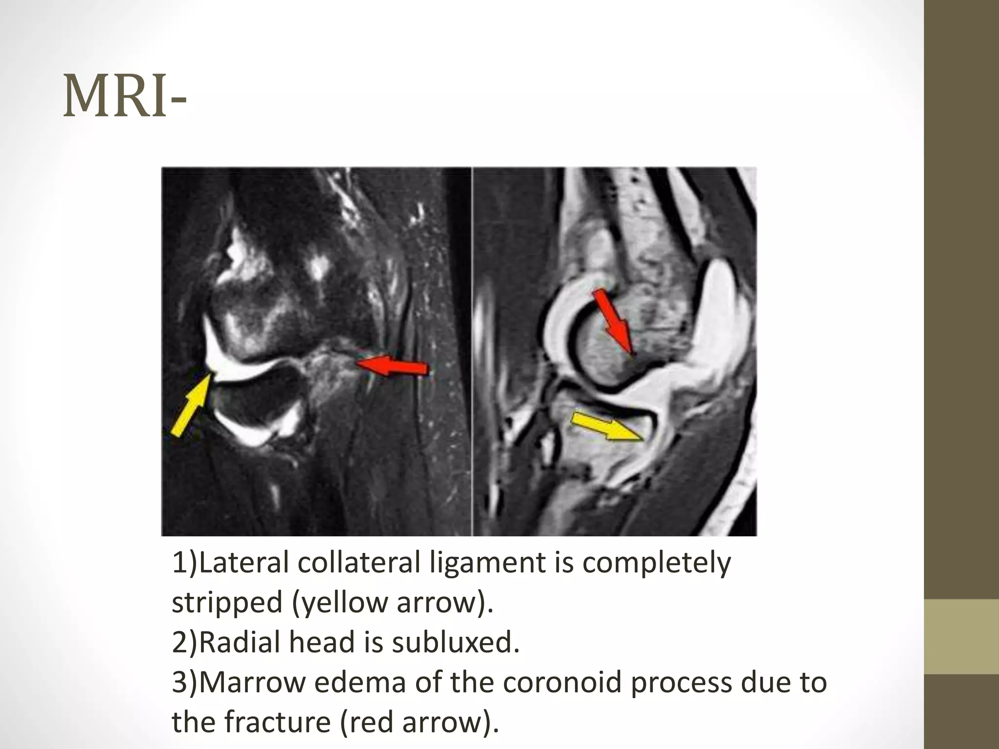 Elbow instability | PPTX