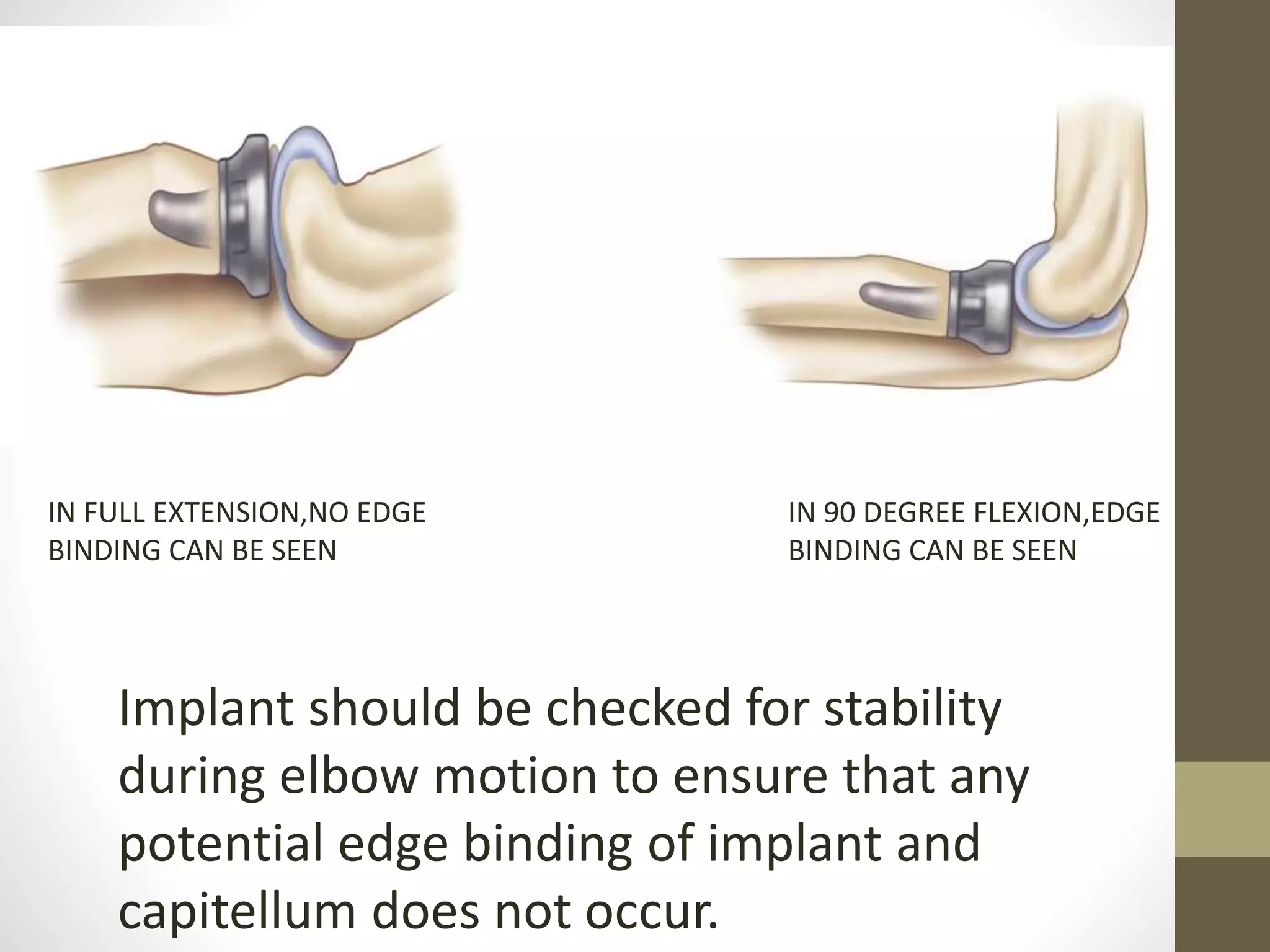 Elbow instability | PPTX