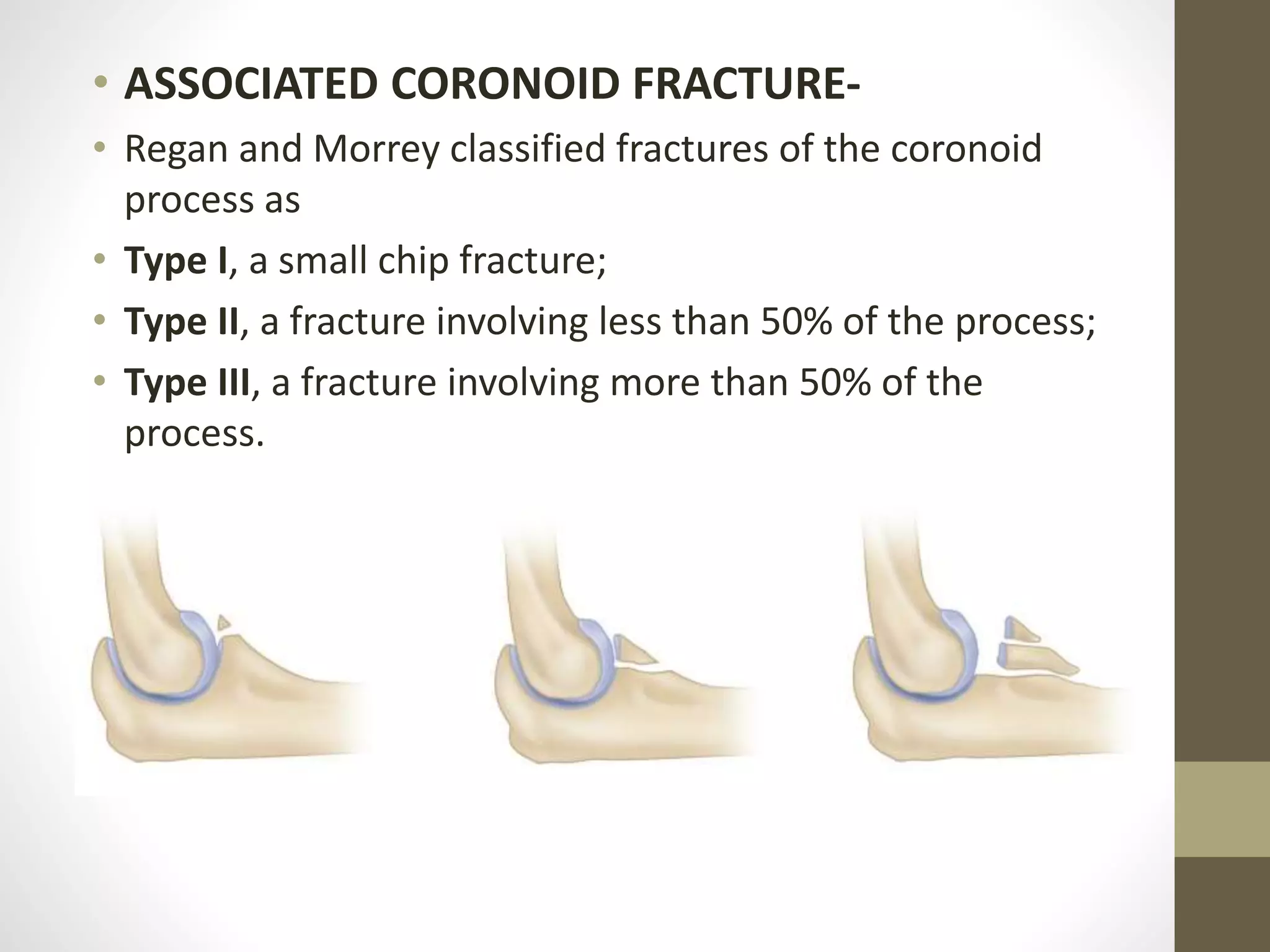 Elbow instability | PPTX