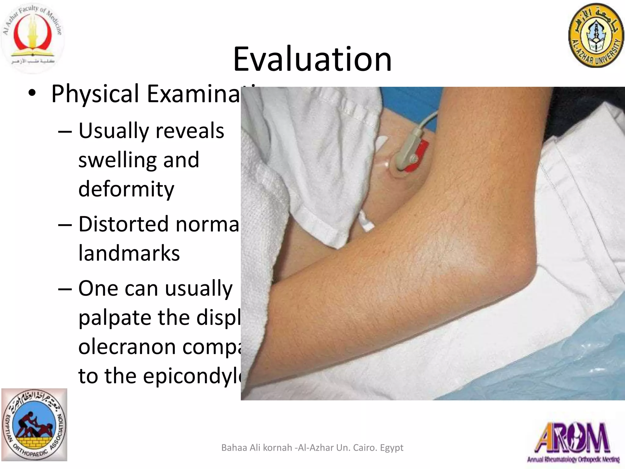 Elbow instability | PPT