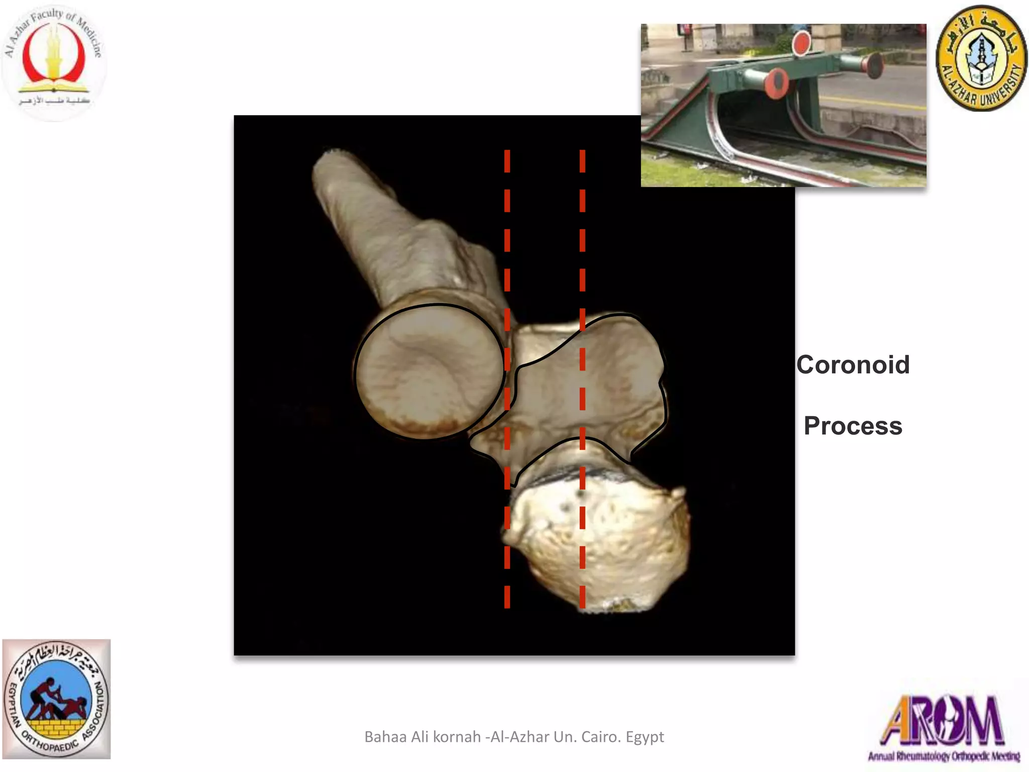 Elbow instability | PPT