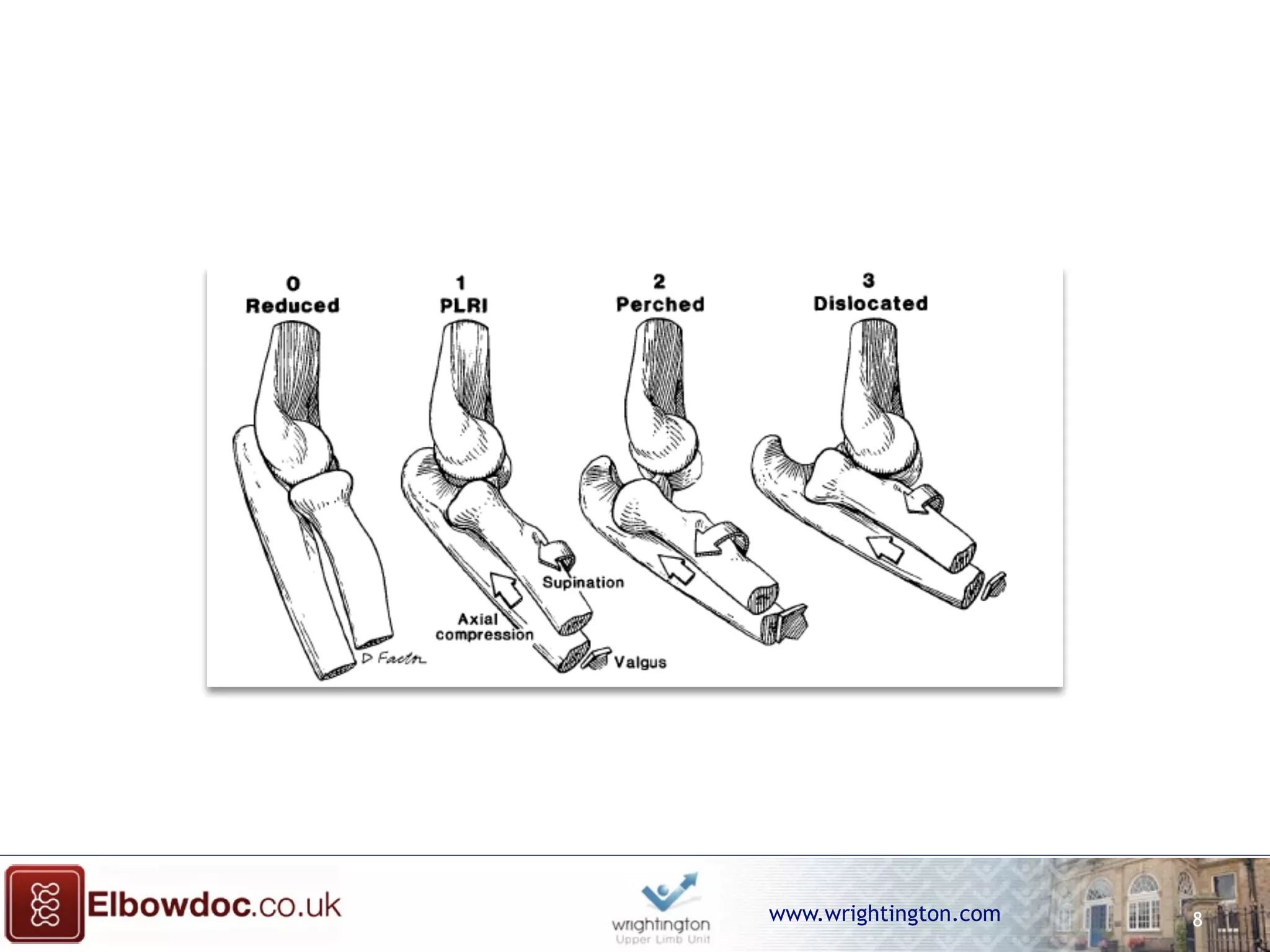 Elbow instability adam watts | PDF