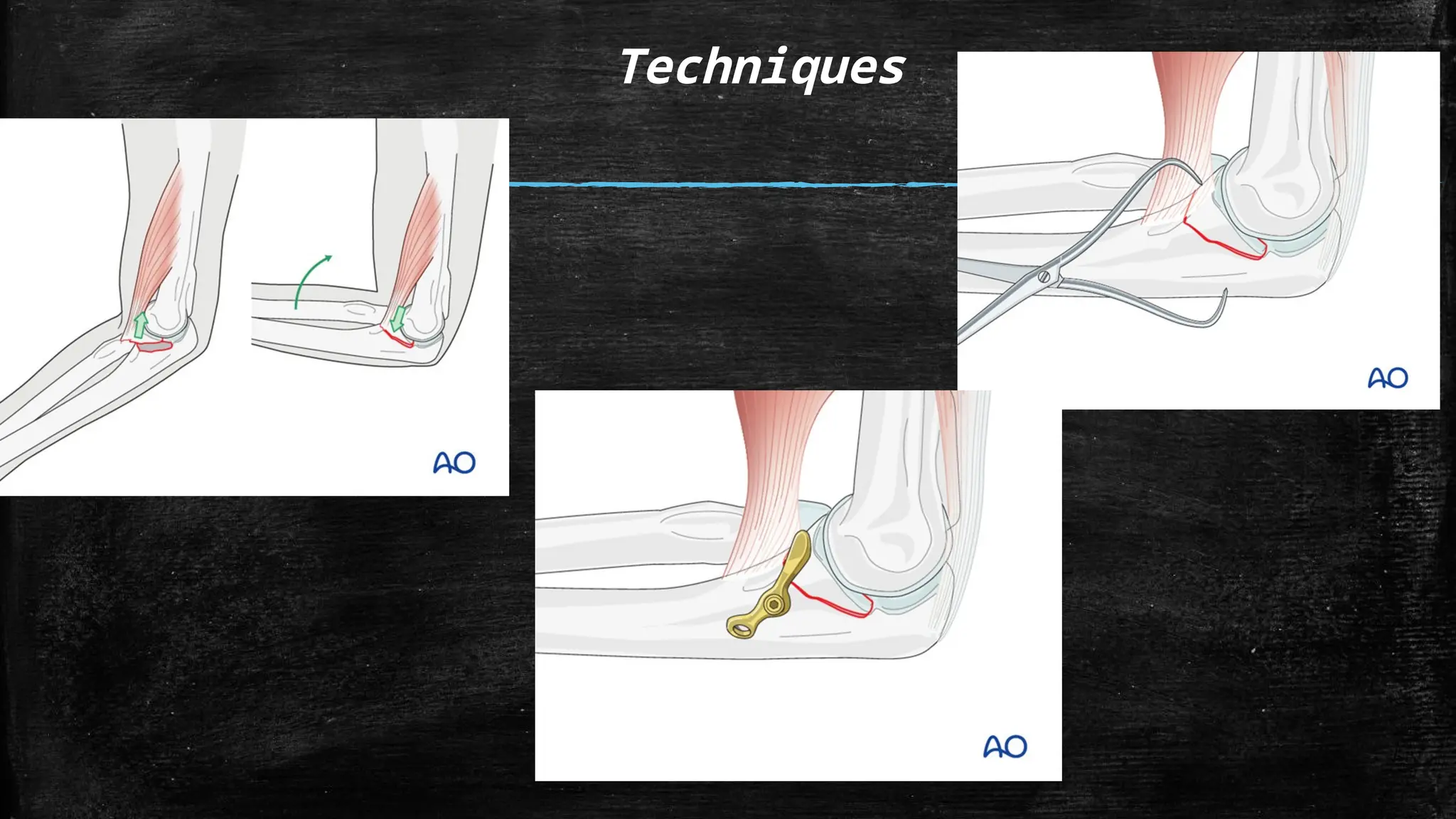 Elbow instability copy.pptxhsjwkabbanansnmama | PPTX