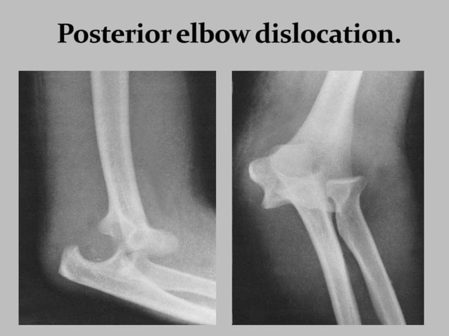 Elbow joint with applied anatomy | PPTX