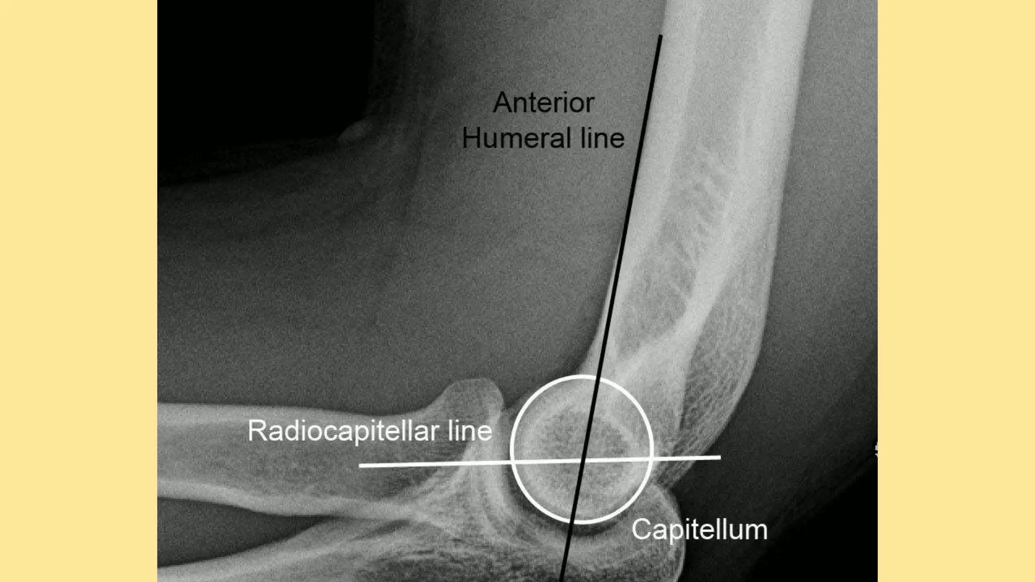Elbow joint anatomy | PPTX