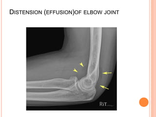 Elbow joint and radio-ulnar joints (1).pptx