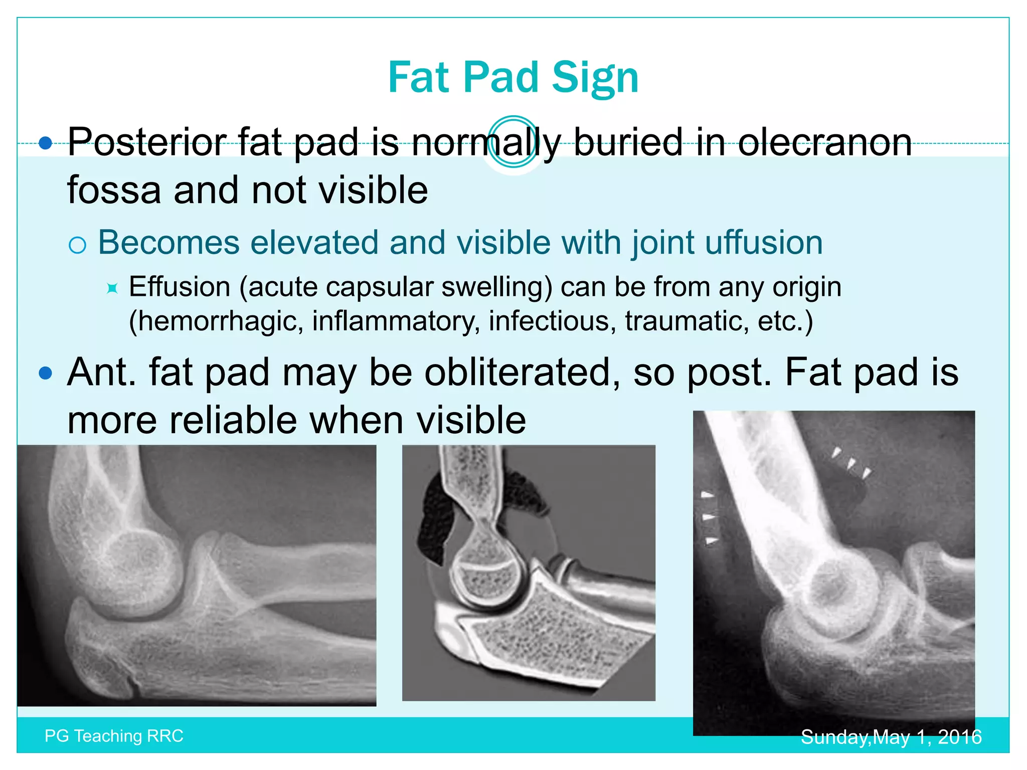Elbow trauma & infection | PPTX