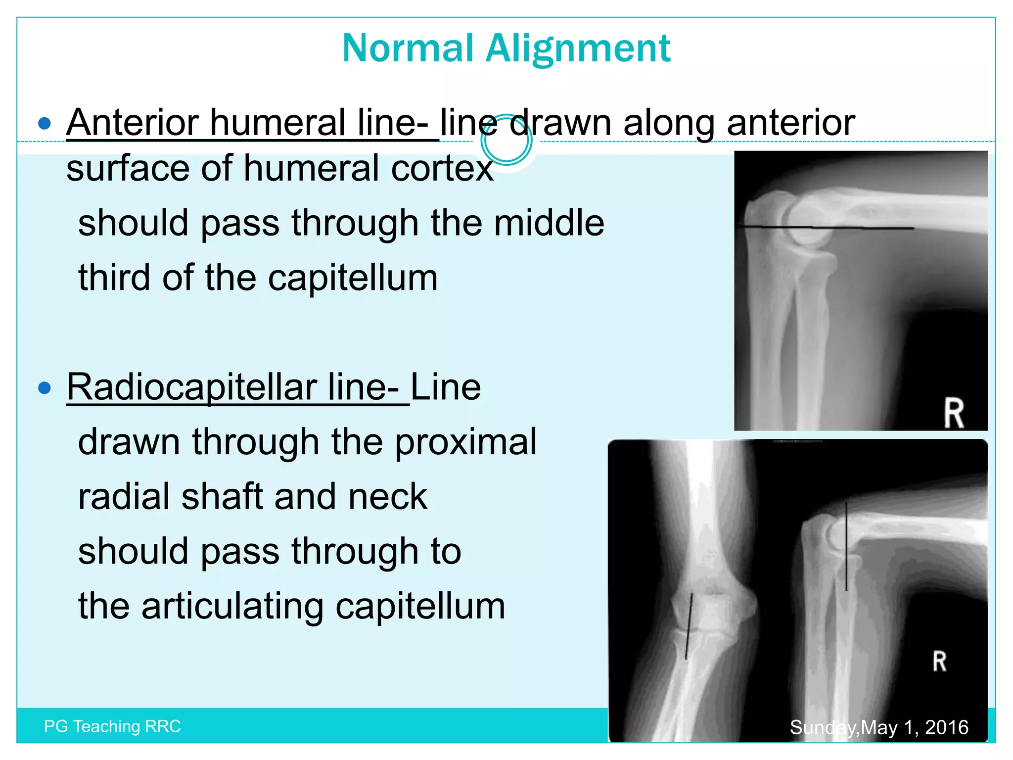 Elbow trauma & infection | PPTX