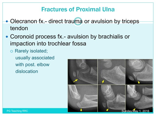 Elbow trauma & infection | PPT