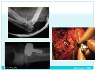Elbow trauma & infection | PPTX