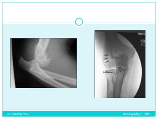 Elbow trauma & infection | PPTX