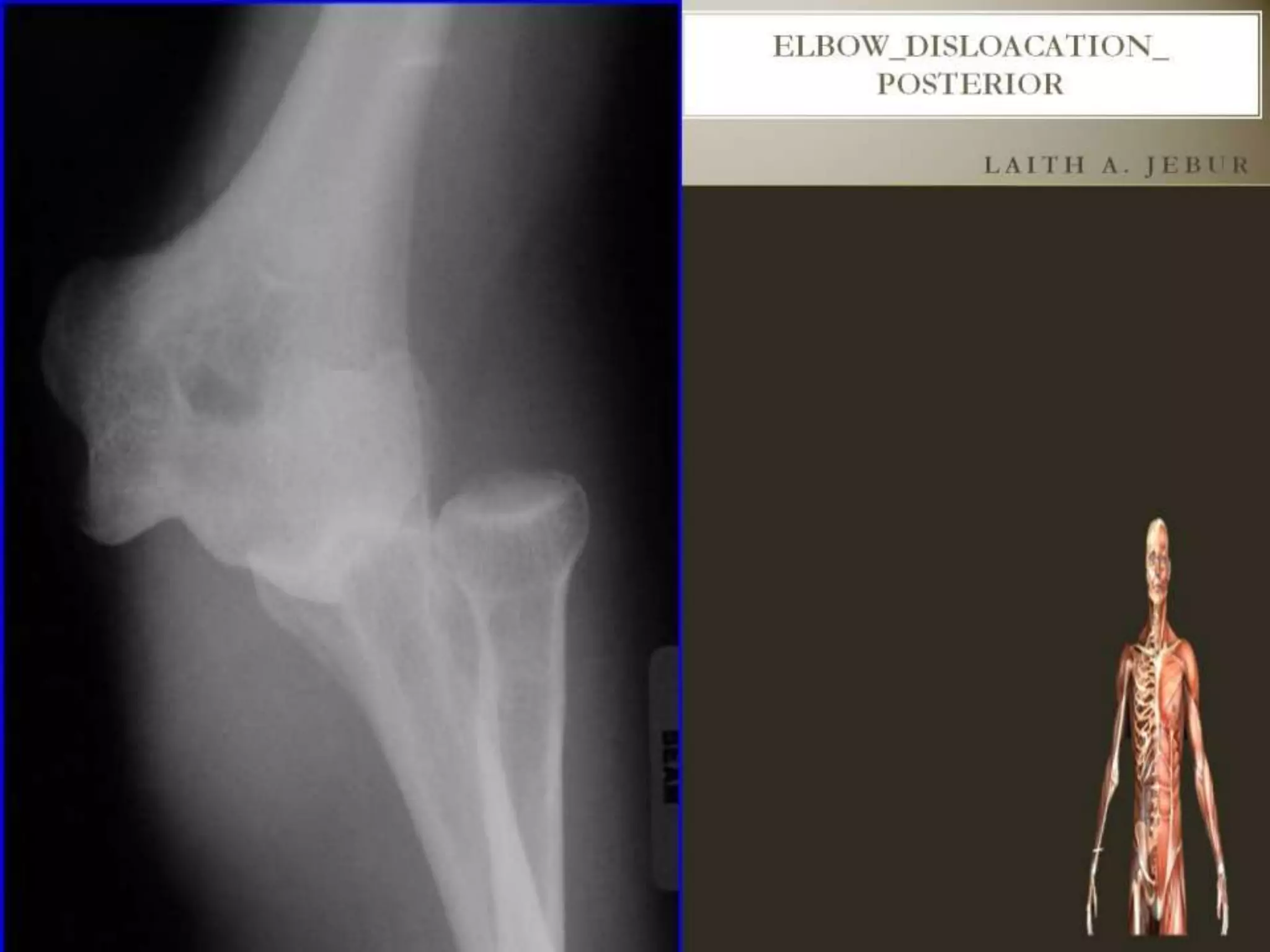 Elbow joint imaging | PPT