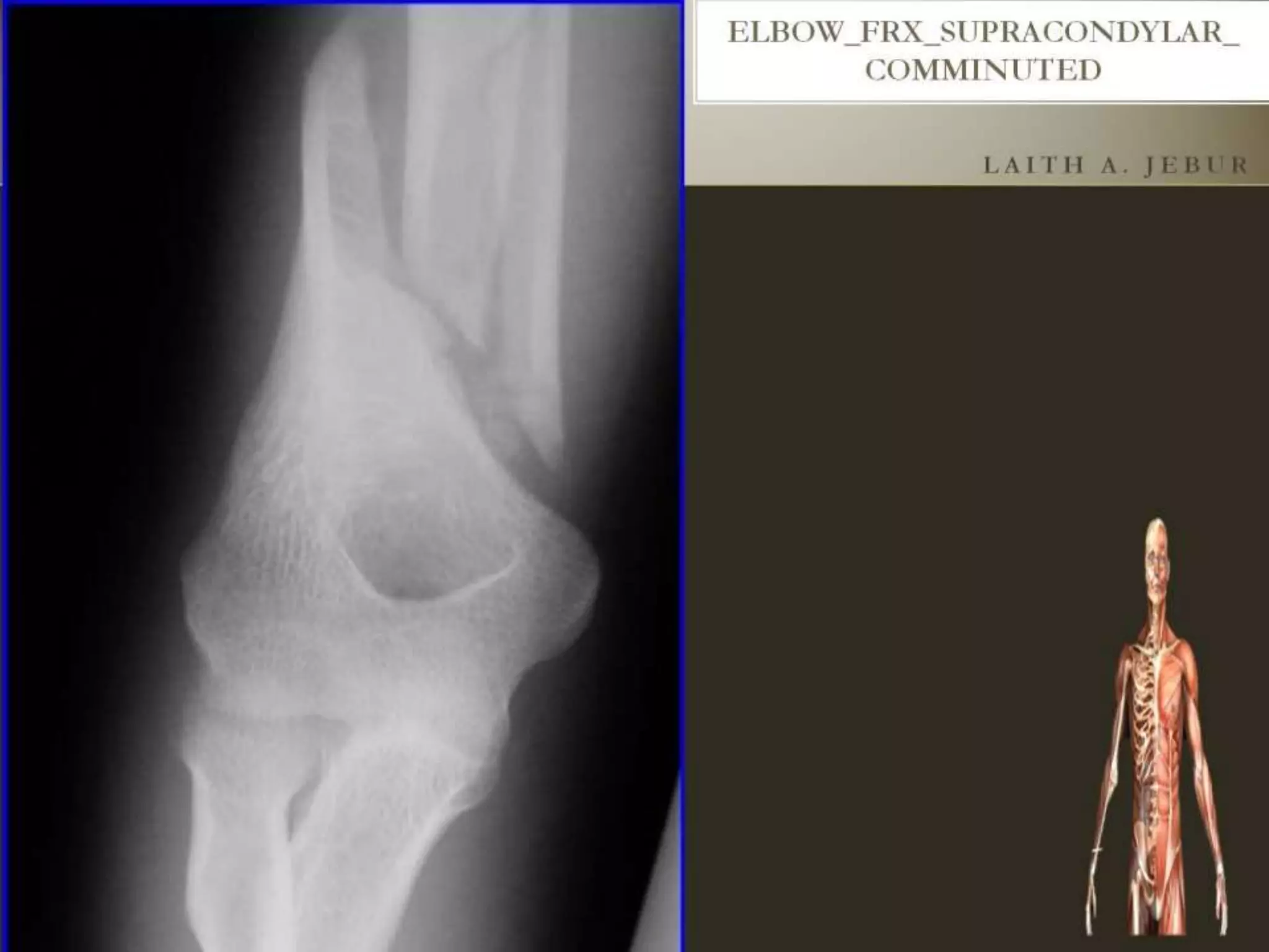 Elbow joint imaging | PPT