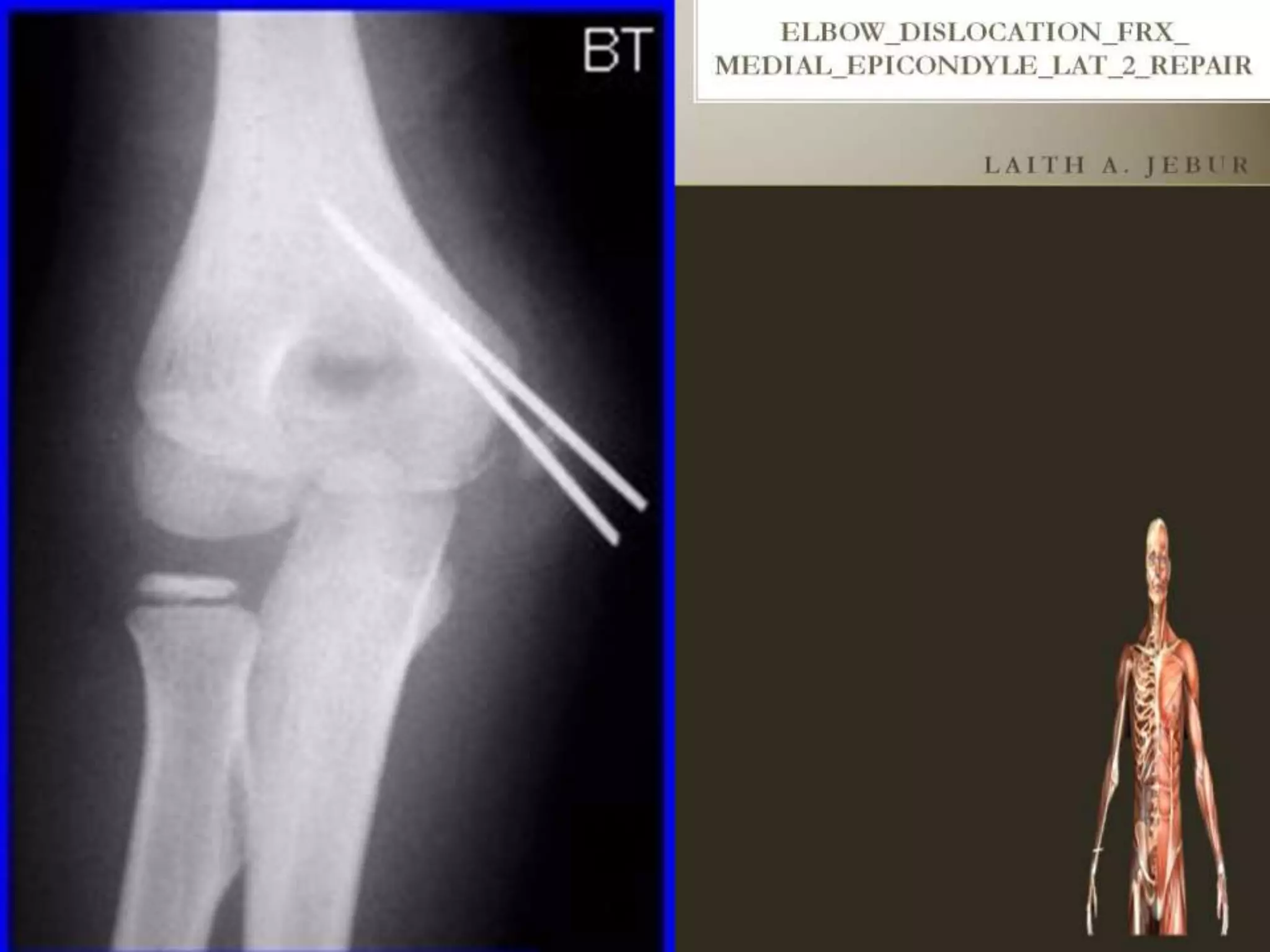 Elbow joint imaging | PPT