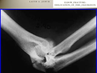 Elbow joint imaging | PPSX
