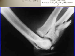 Elbow joint imaging | PPT