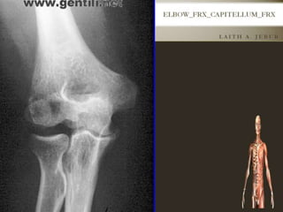 Elbow joint imaging | PPT