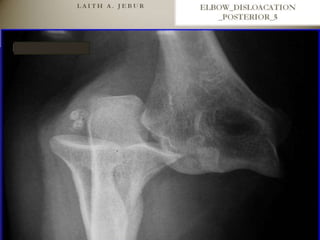 Elbow joint imaging | PPSX