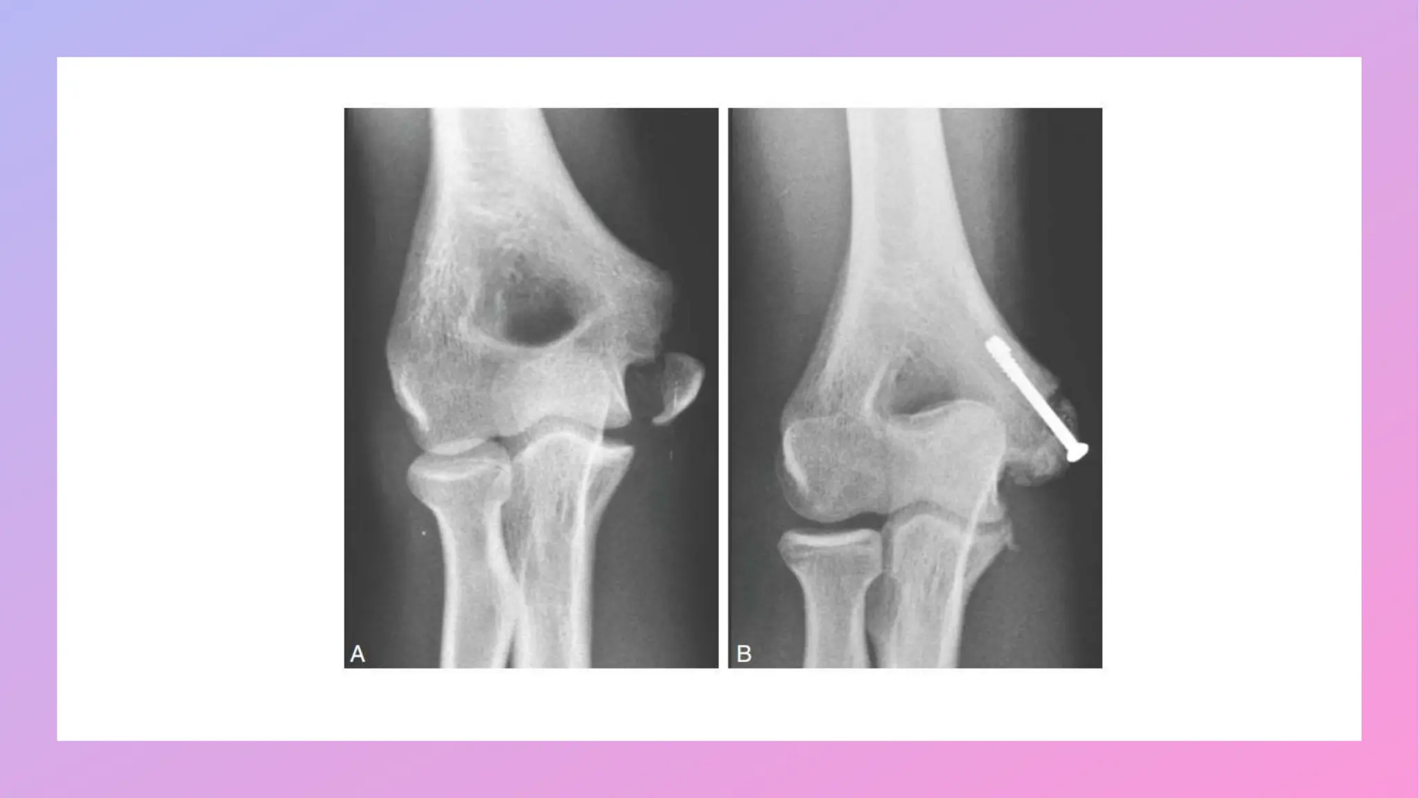 ELBOW JOINT PATHOLOGY AND REHABILITATION 1.pptx