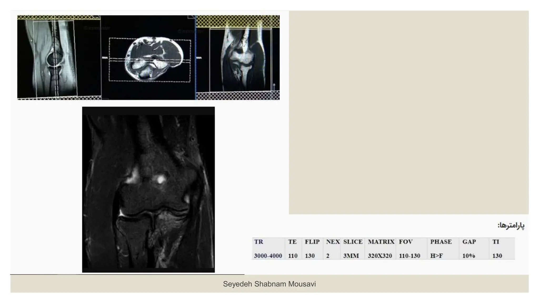 Elbow MRI.pptxPositioning. Technique. Physics. Anatomy. | PPT