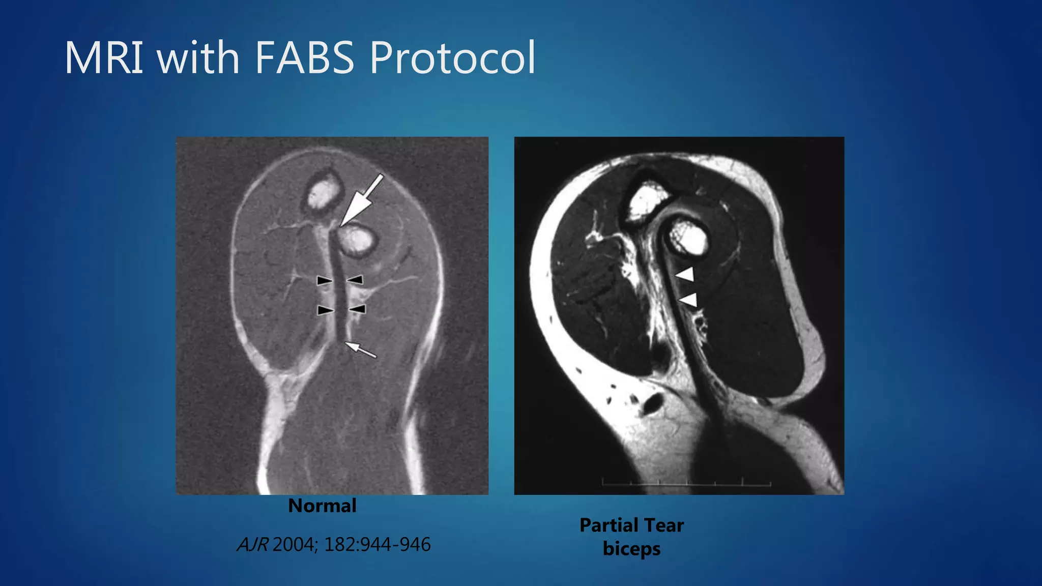 Distal Biceps Tendon Ruptures | Elbow Tendinopathies | South Windsor ...
