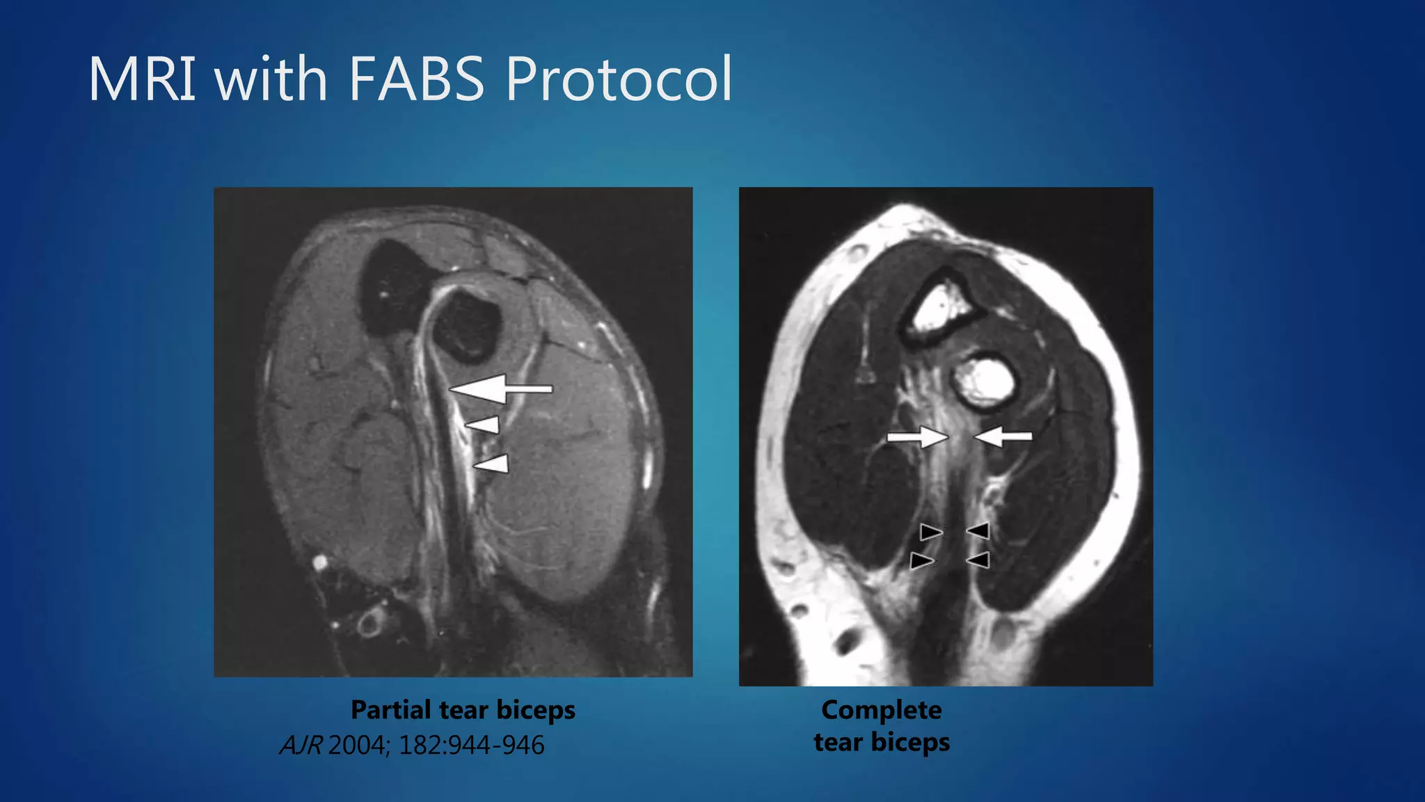 Distal Biceps Tendon Ruptures | Elbow Tendinopathies | South Windsor ...