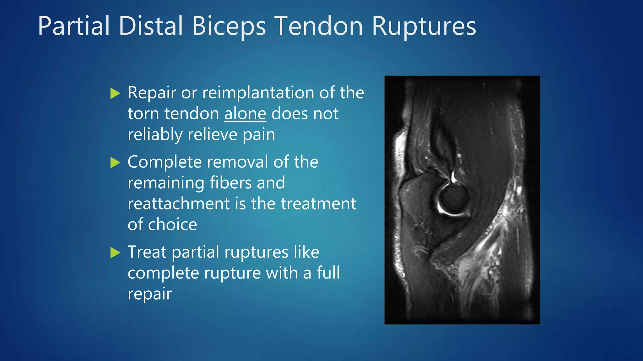 Distal Biceps Tendon Ruptures | Elbow Tendinopathies | South Windsor ...