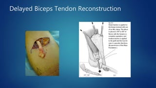 Distal Biceps Tendon Ruptures | Elbow Tendinopathies | South Windsor ...