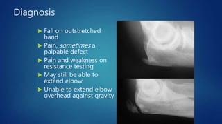 Distal Biceps Tendon Ruptures | Elbow Tendinopathies | South Windsor ...