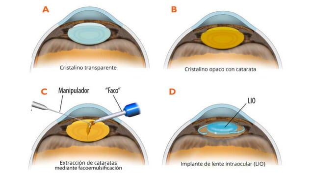 el cristalino y sus alteraciones patológicas #1.pdf