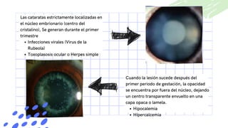 el cristalino y sus alteraciones patológicas #1.pdf