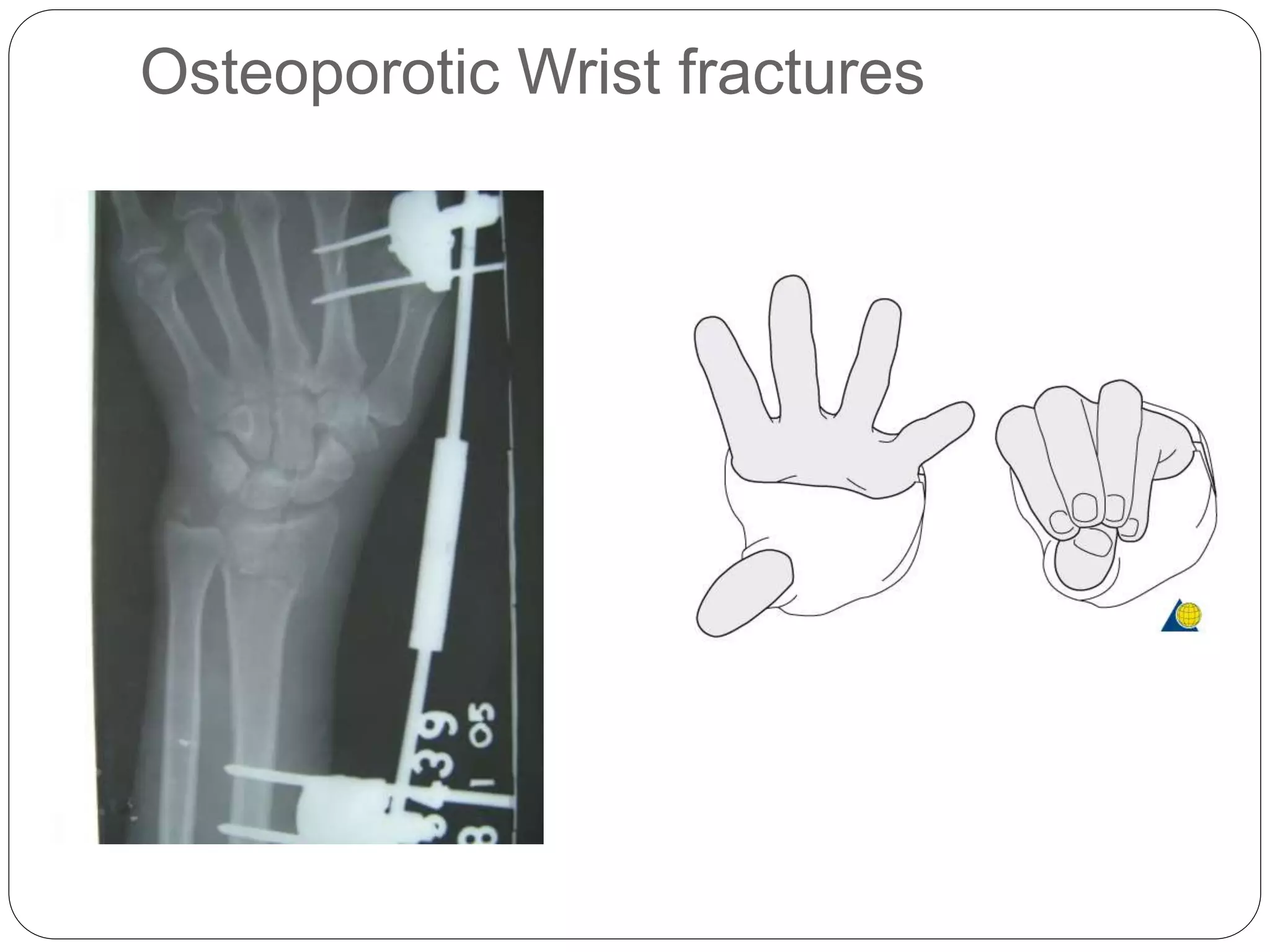 Common Musculoskeletal (orthopedic) disorders in elderly | PPTX