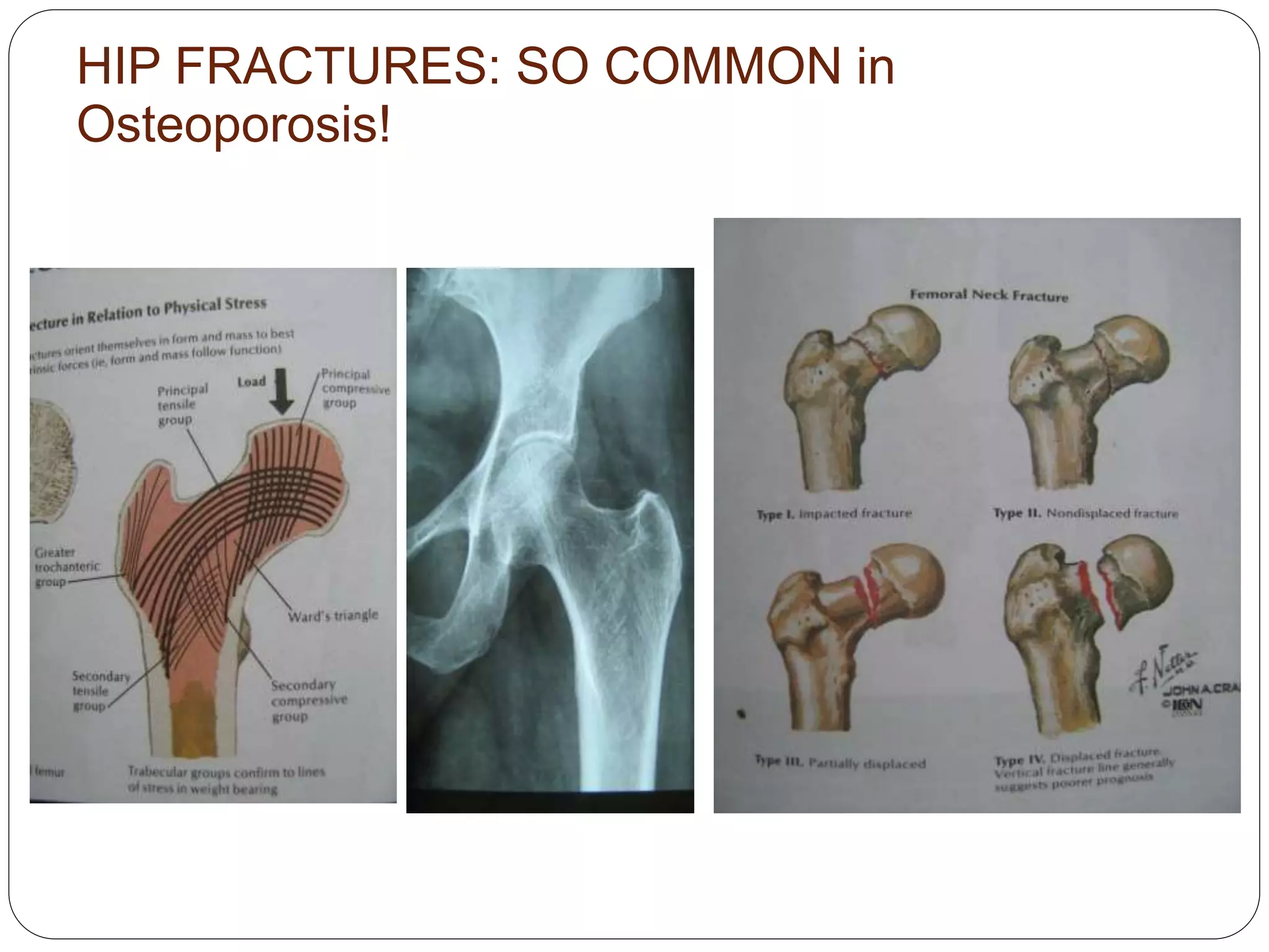 Common Musculoskeletal (orthopedic) disorders in elderly | PPTX