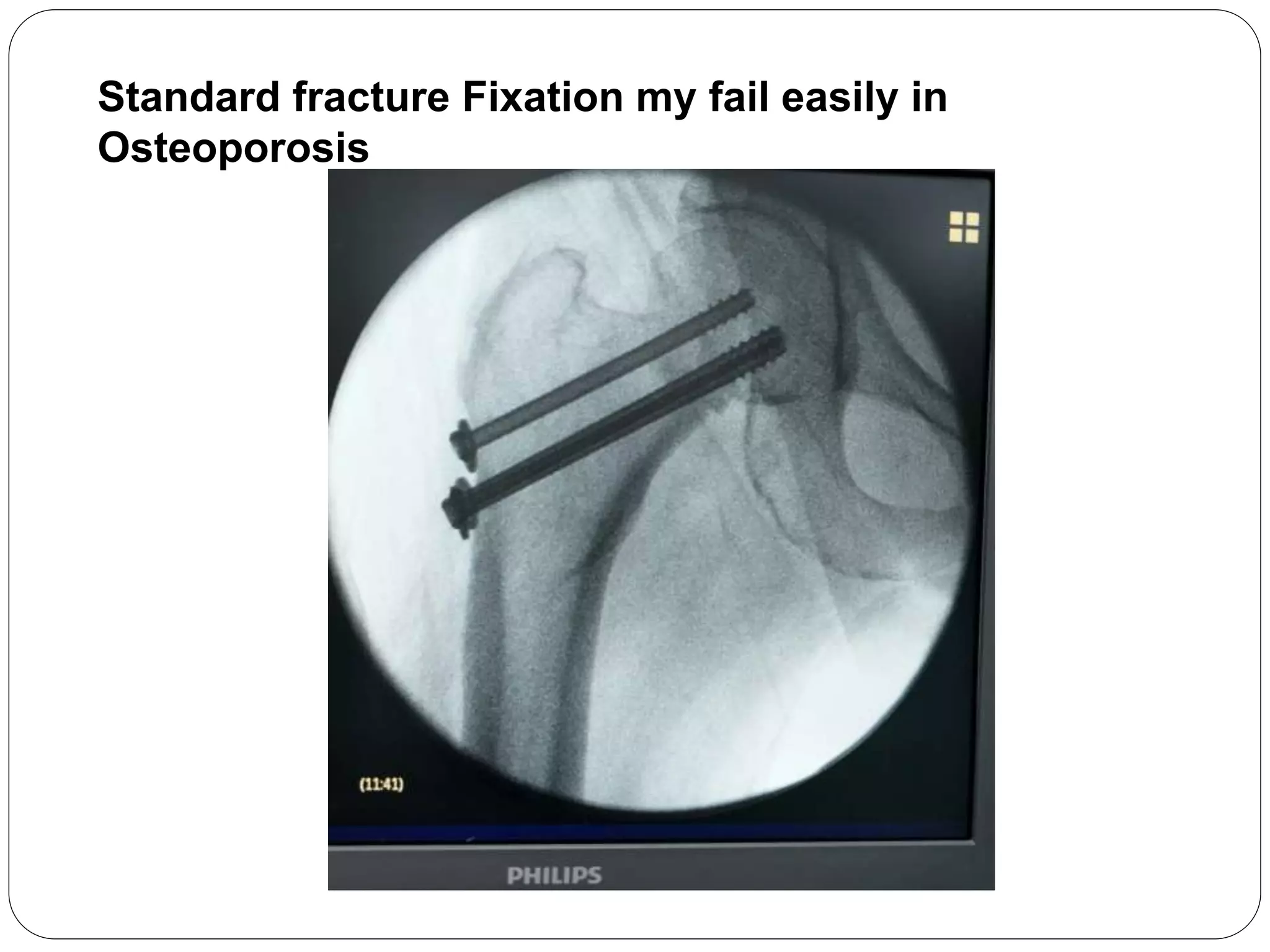 Common Musculoskeletal (orthopedic) disorders in elderly | PPTX