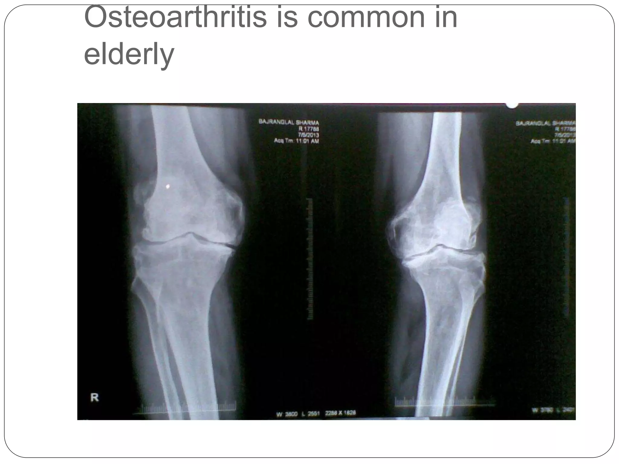 Common Musculoskeletal (orthopedic) disorders in elderly | PPTX