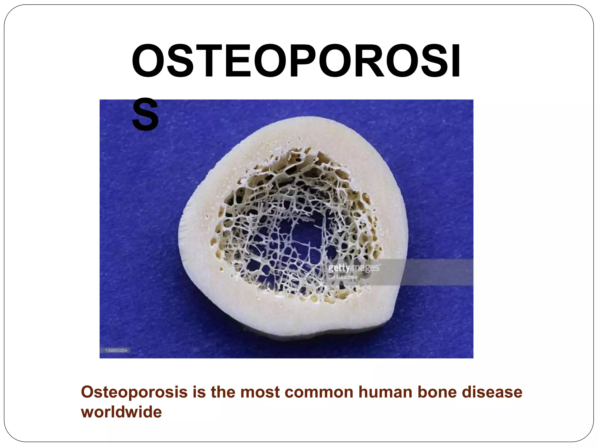 Common Musculoskeletal (orthopedic) disorders in elderly | PPTX