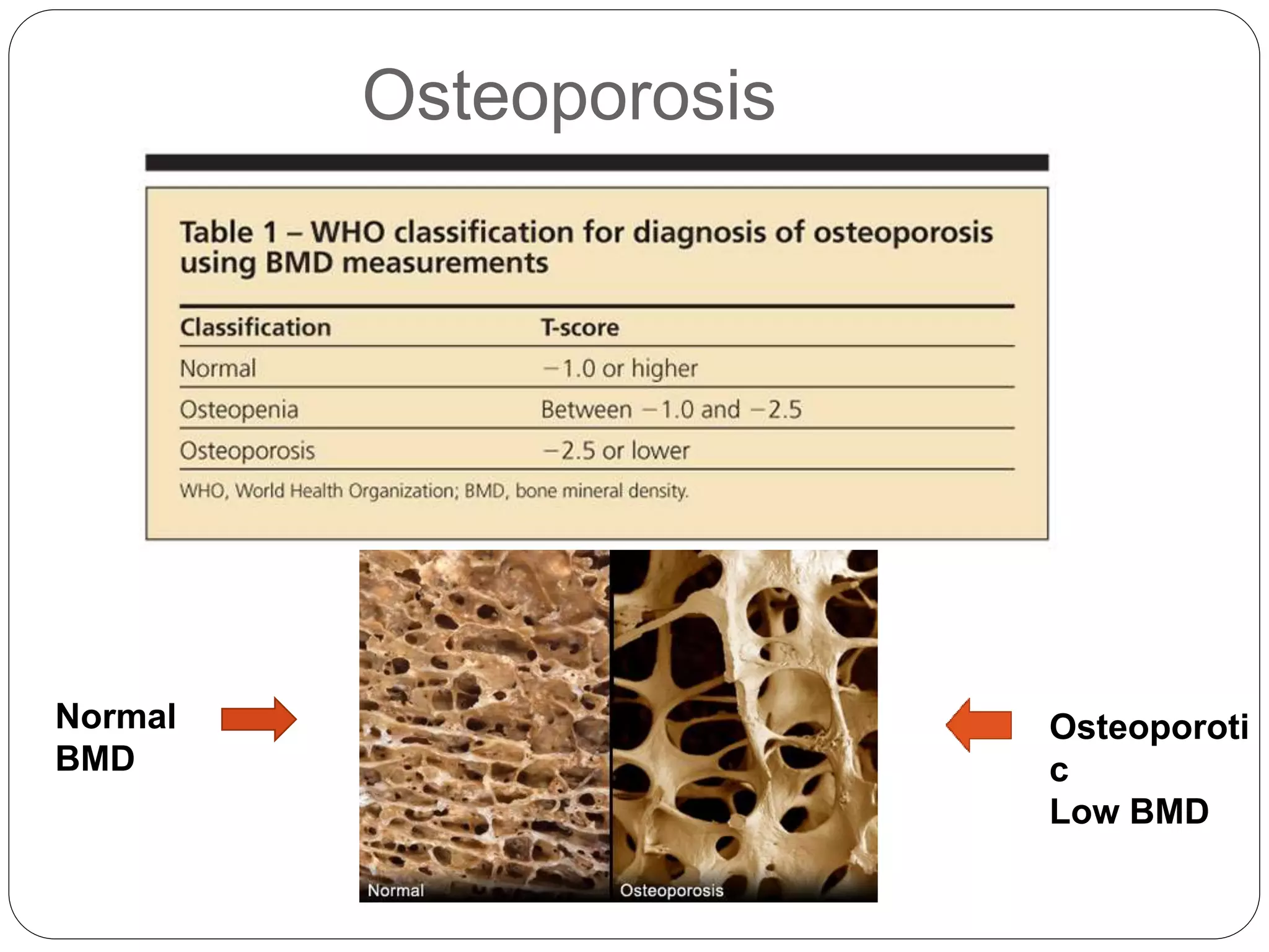 Common Musculoskeletal (orthopedic) disorders in elderly | PPTX